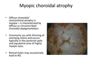 3 mirror, retinal break.pptx