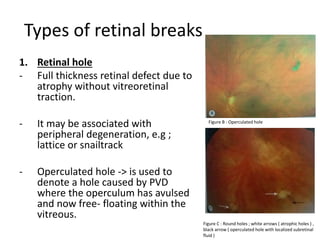 3 mirror, retinal break.pptx