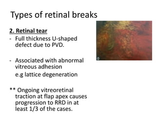 3 mirror, retinal break.pptx