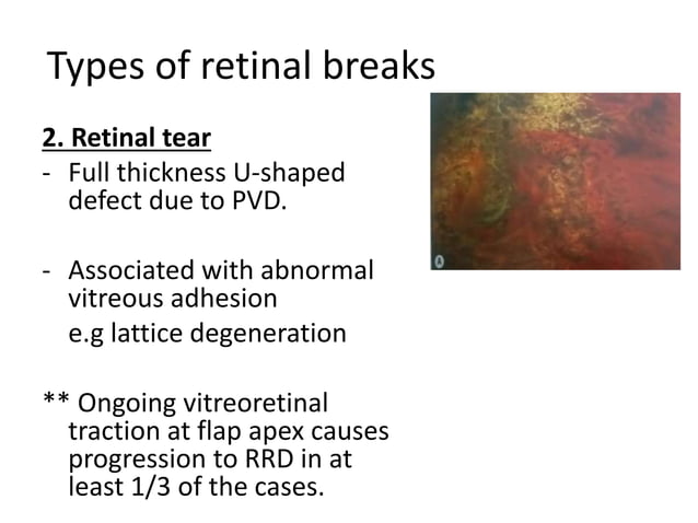 3 mirror, retinal break.pptx | Eye and Vision Conditions | Diseases and ...