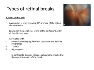 3 mirror, retinal break.pptx