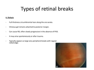 3 mirror, retinal break.pptx