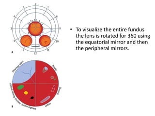 3 mirror, retinal break.pptx