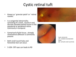 3 mirror, retinal break.pptx