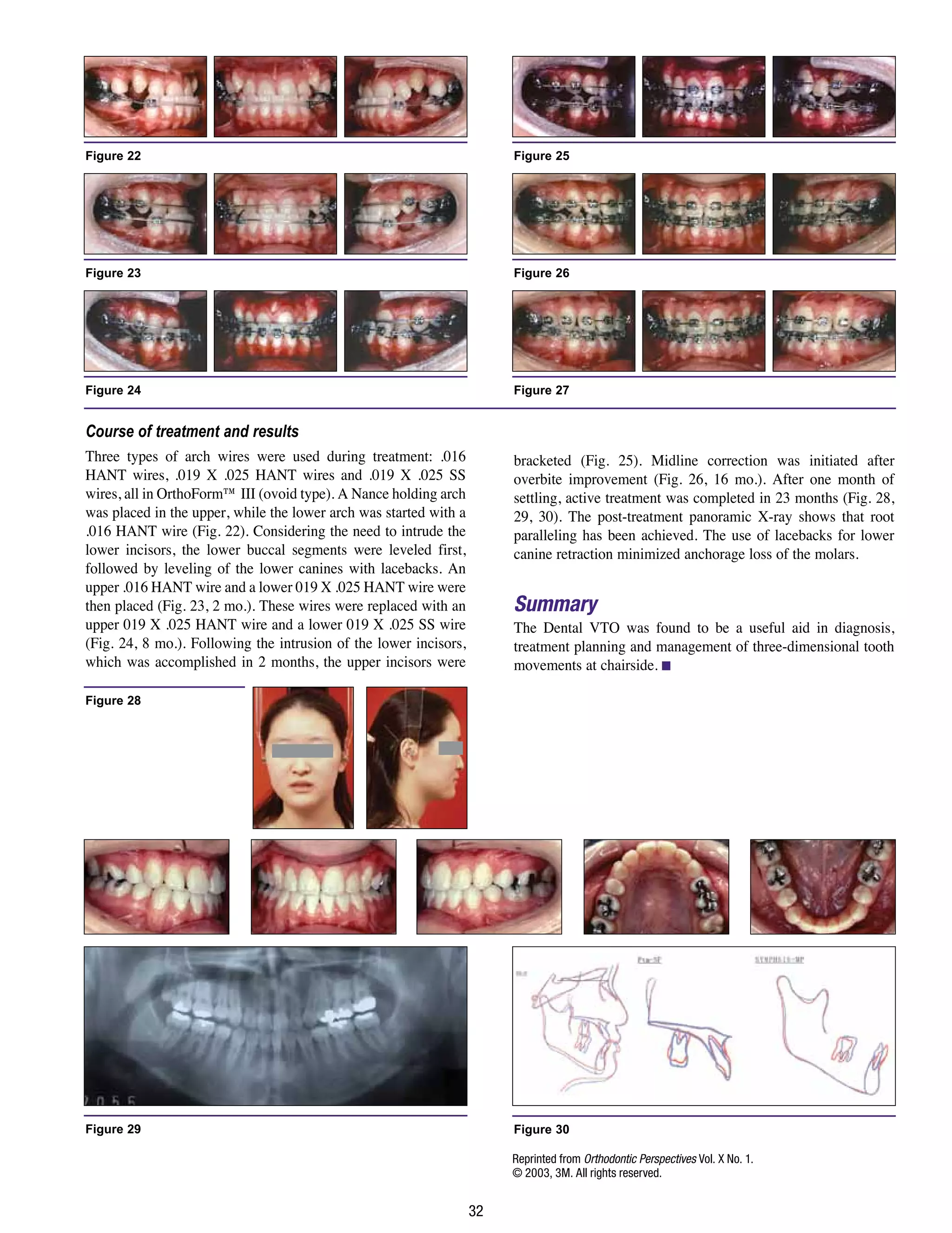 MBT TECHNIQUE - ORTHODONTIC EDUCATION FOR GENERAL PRACTITIONERS. | PDF