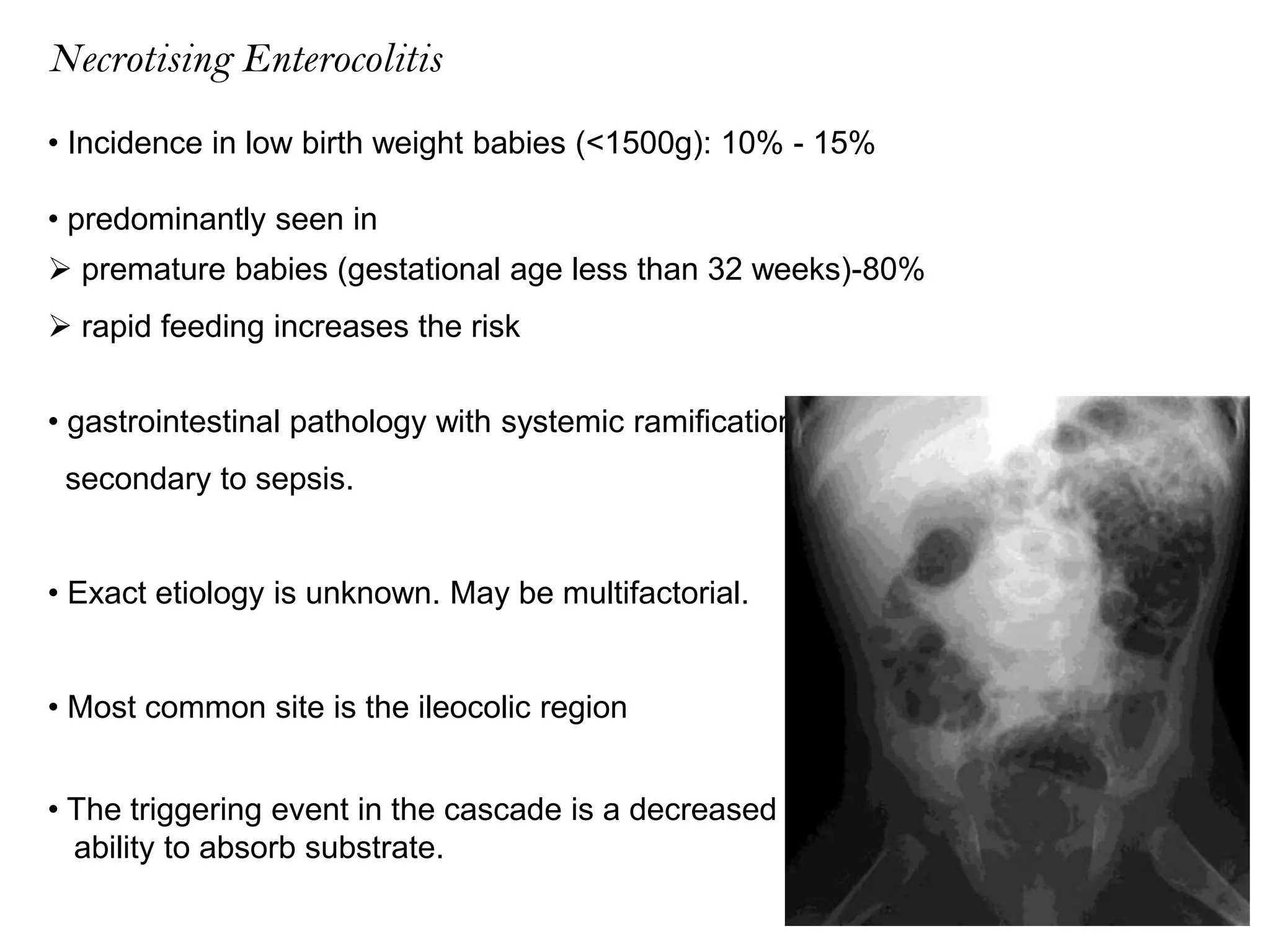 Necrotising Enterocolitis and Anesthesia | PPTX