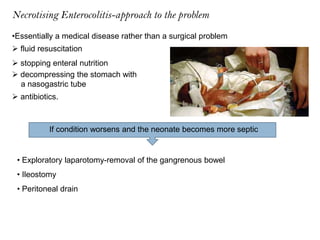 Necrotising Enterocolitis and Anesthesia | PPTX
