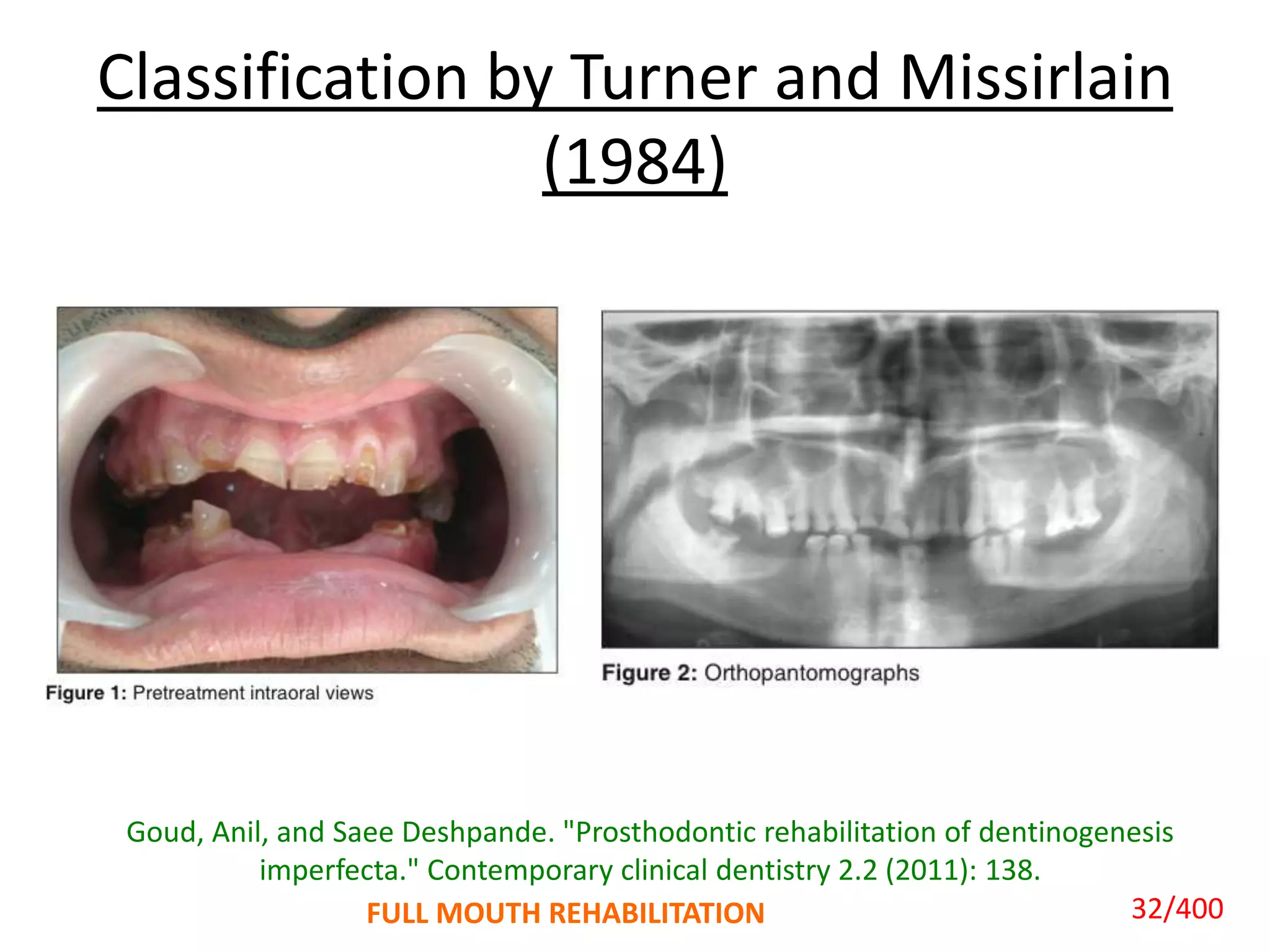 Full Mouth Rehabilitation | PPTX