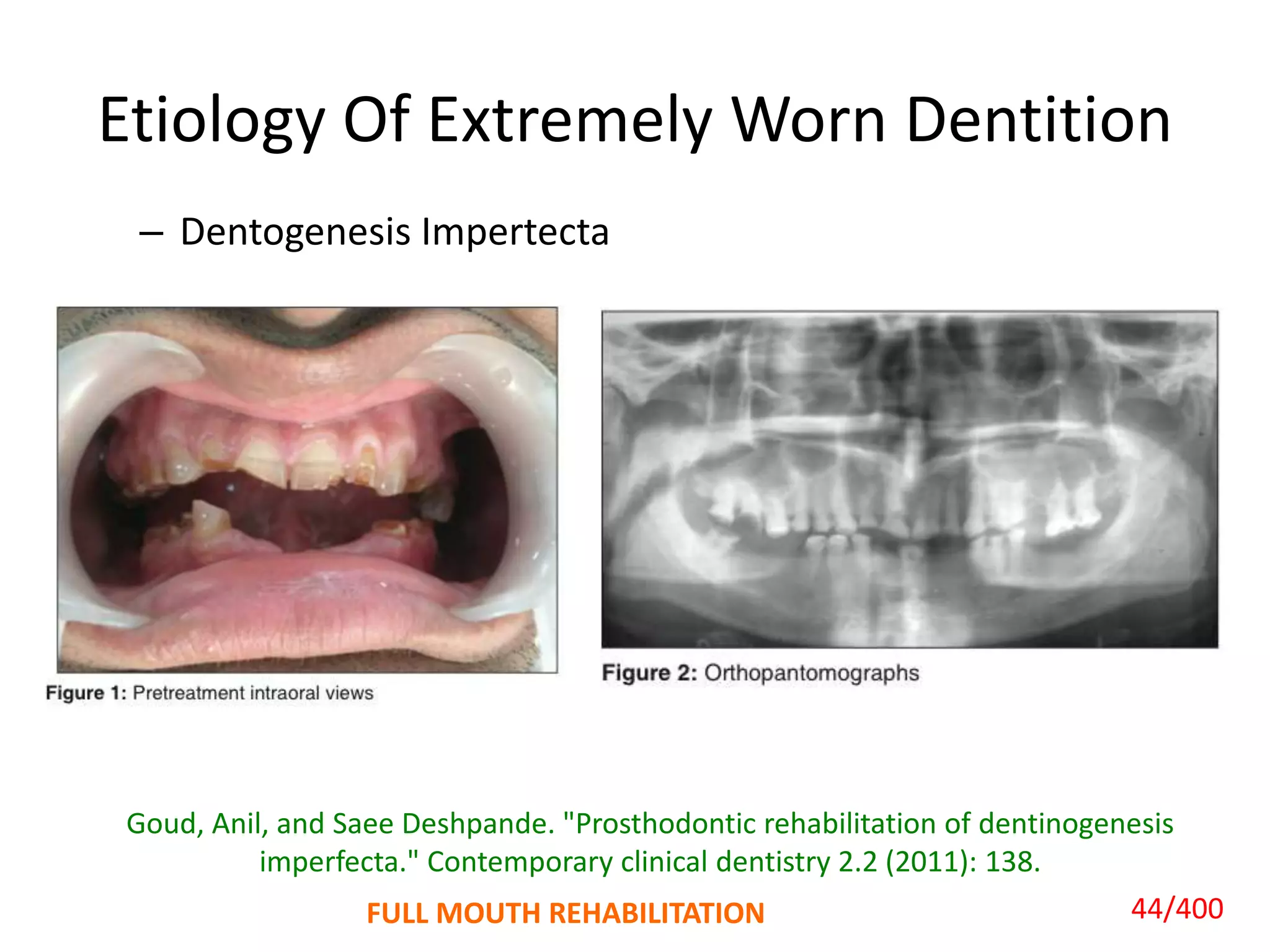 Full Mouth Rehabilitation | PPTX