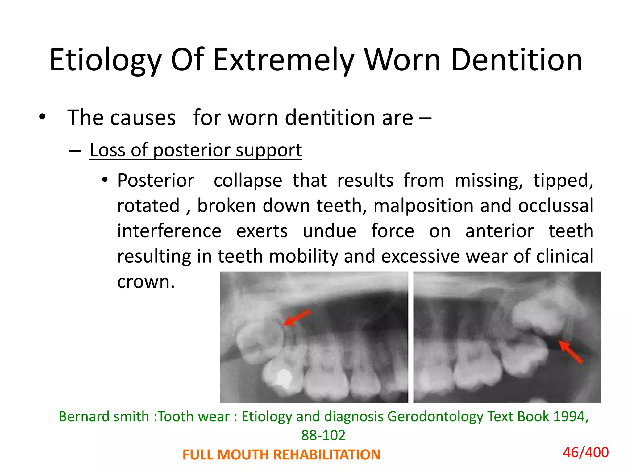 Full Mouth Rehabilitation | PPTX