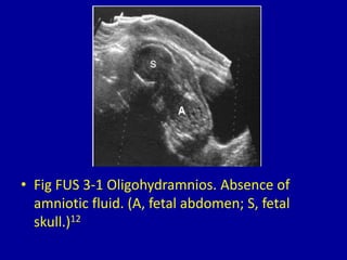 Oligohydramnios Ultrasound