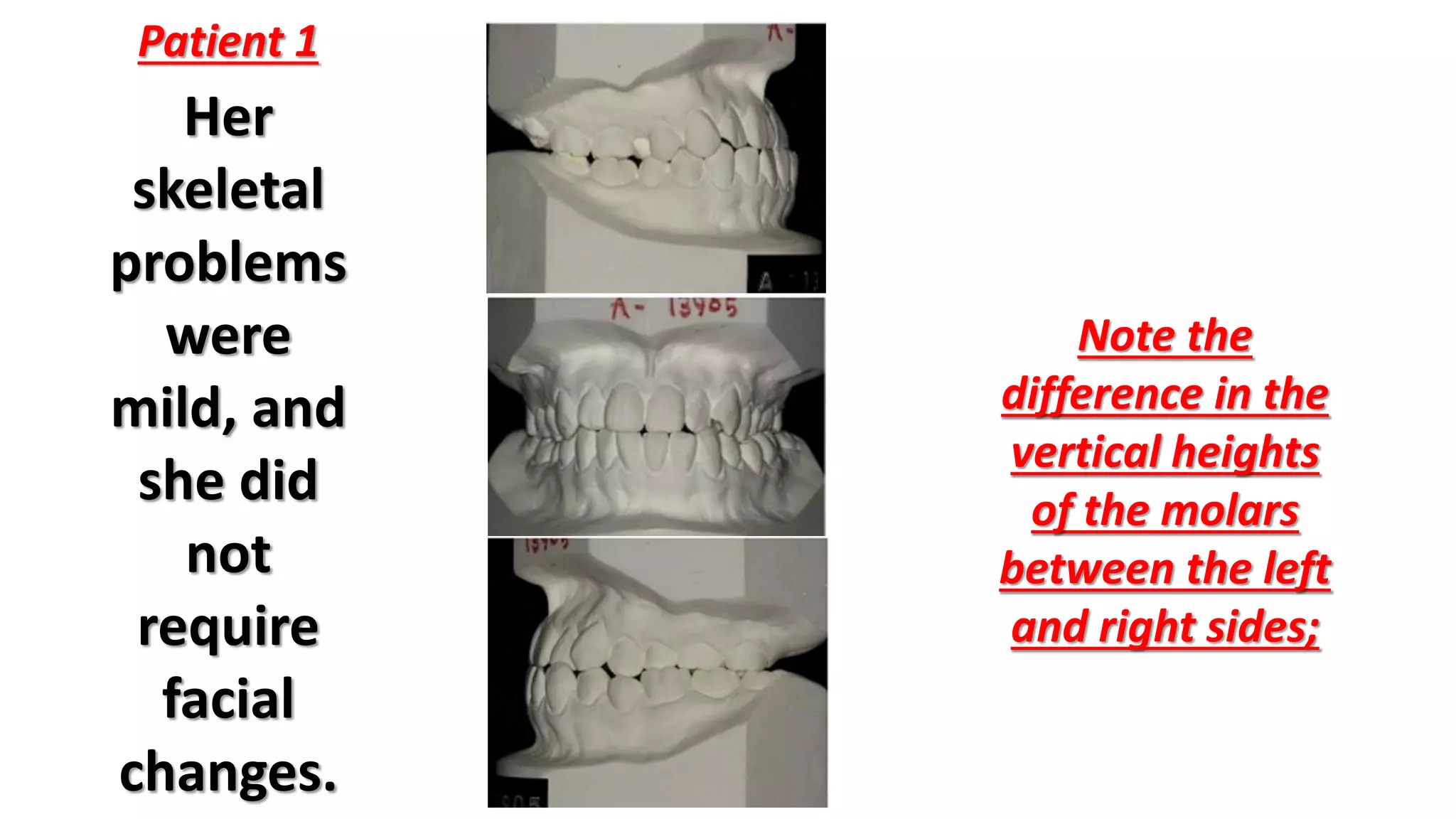 orthodontic correction of occlusal plane canting PART 3 | PPTX