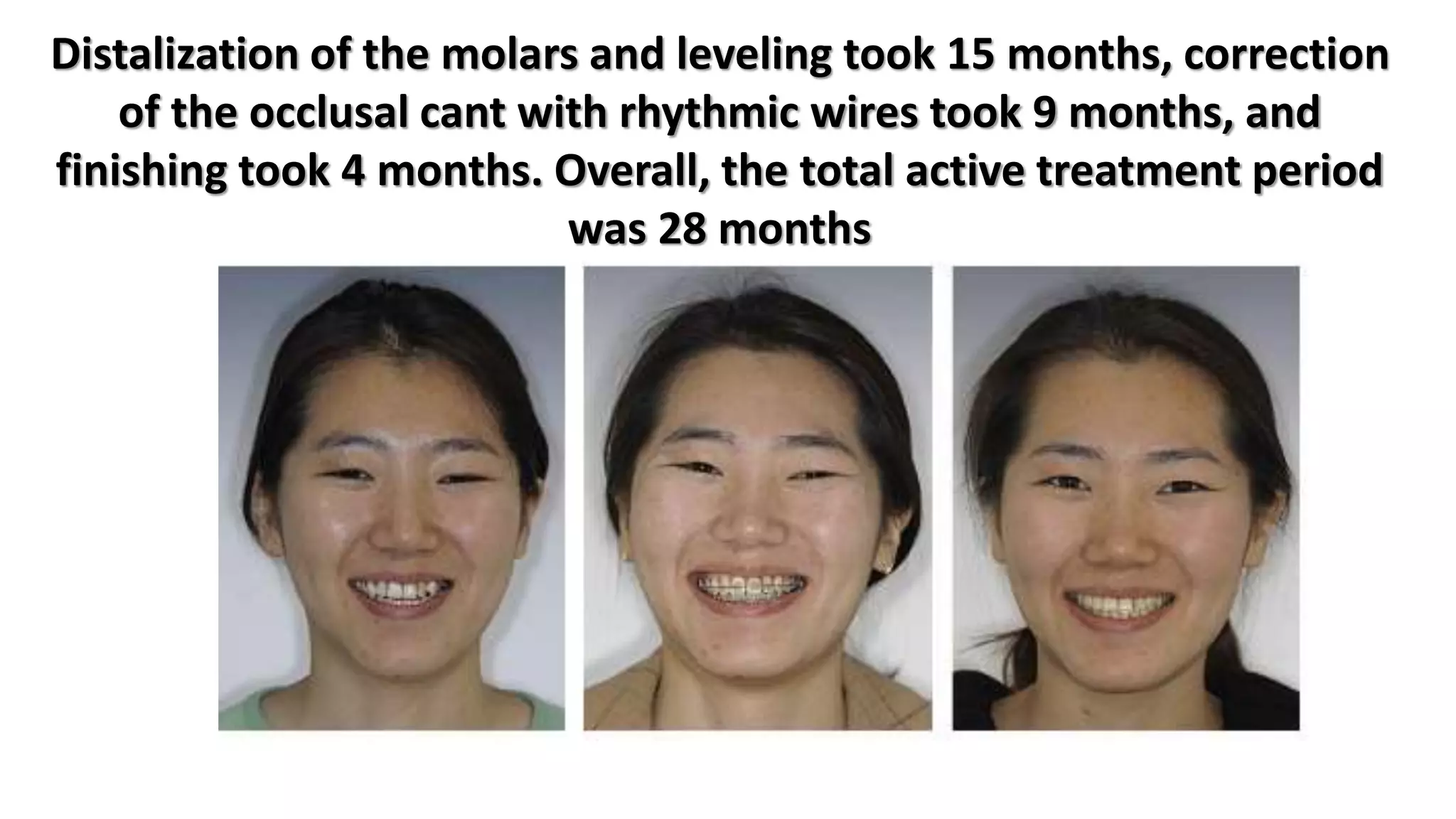 orthodontic correction of occlusal plane canting PART 3 | PPTX