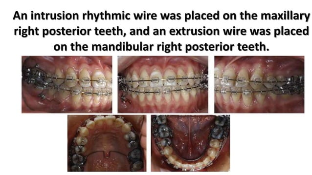 orthodontic correction of occlusal plane canting PART 3 | PPTX