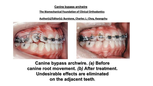 orthodontic correction of occlusal plane canting PART 3
