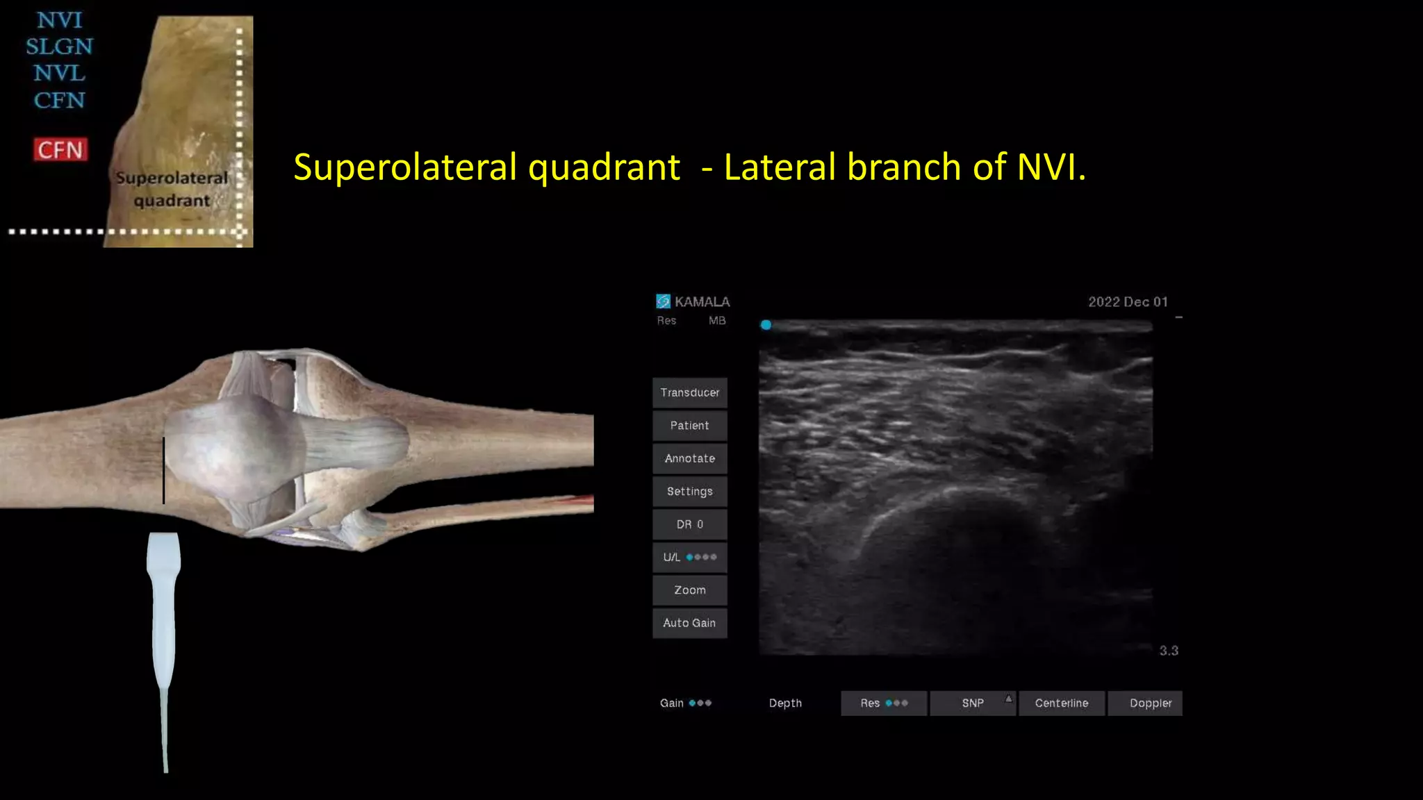 Osteoarthritis Knee.pptx