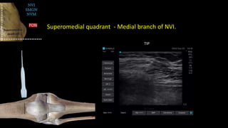 Osteoarthritis Knee.pptx