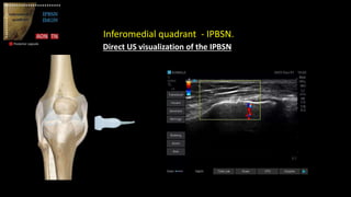 Osteoarthritis Knee.pptx