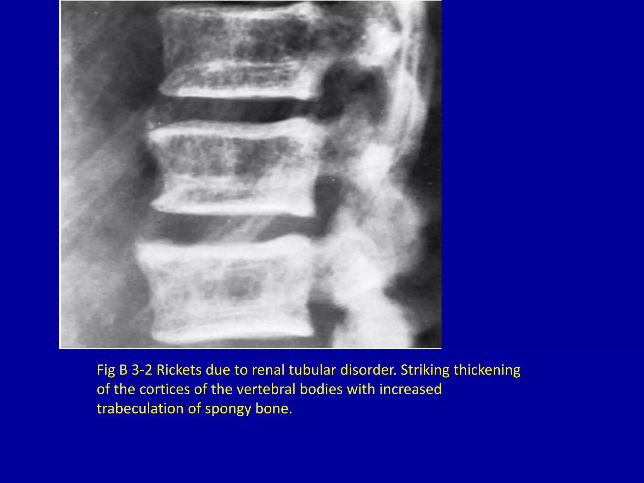 3 osteomalacia | PPTX