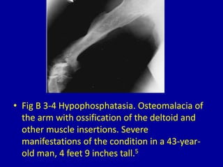 3 osteomalacia | PPTX