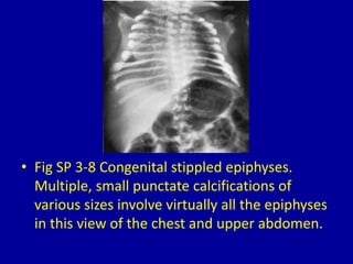 3 osteosclerotic vertebral lesions | PPTX