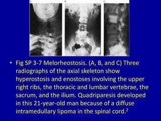 3 osteosclerotic vertebral lesions | PPTX