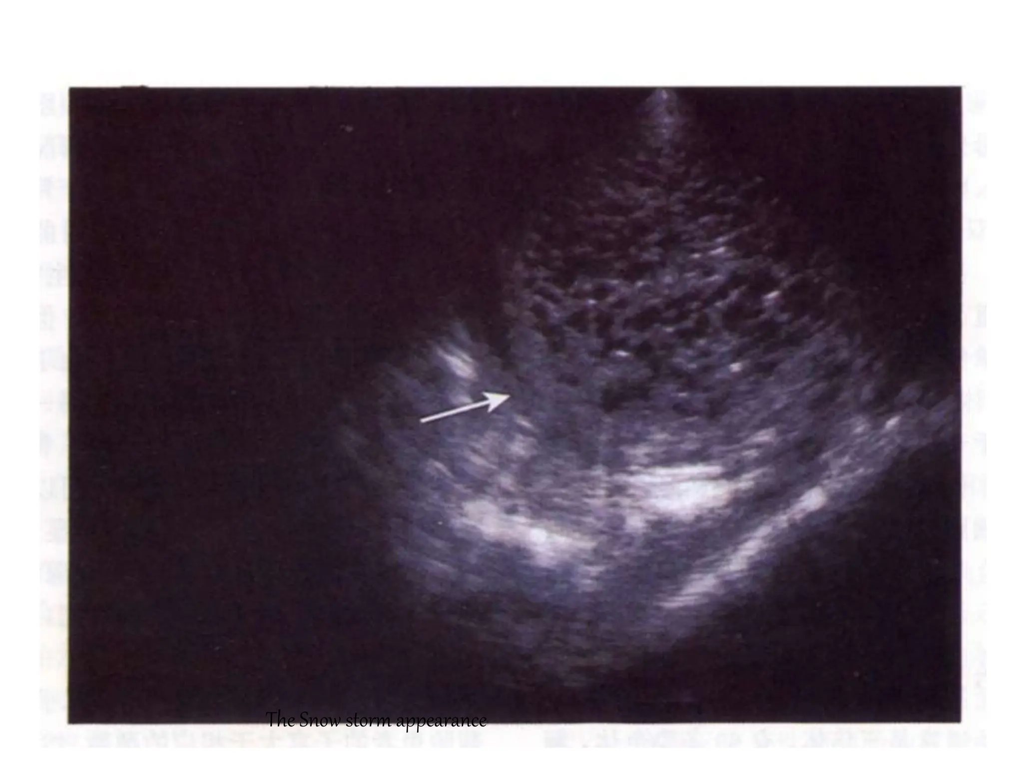 3 (part 2) Gestational Trophoblastic Disease .ppt