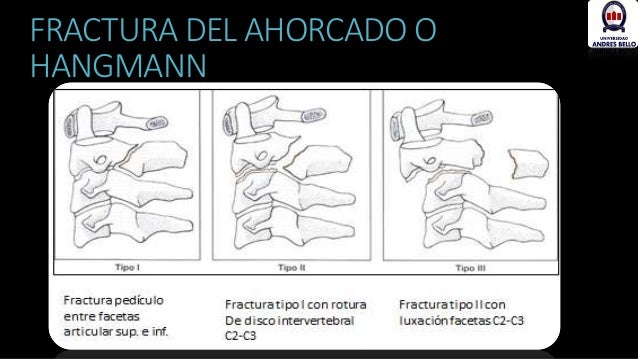 Patolog a Radiol gica De La Columna Vertebral Patolog a Radiol gica De La Columna Vertebral