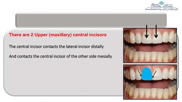 3= Permanent maxillary Central incisor.pptx | Dental Health | Diseases ...