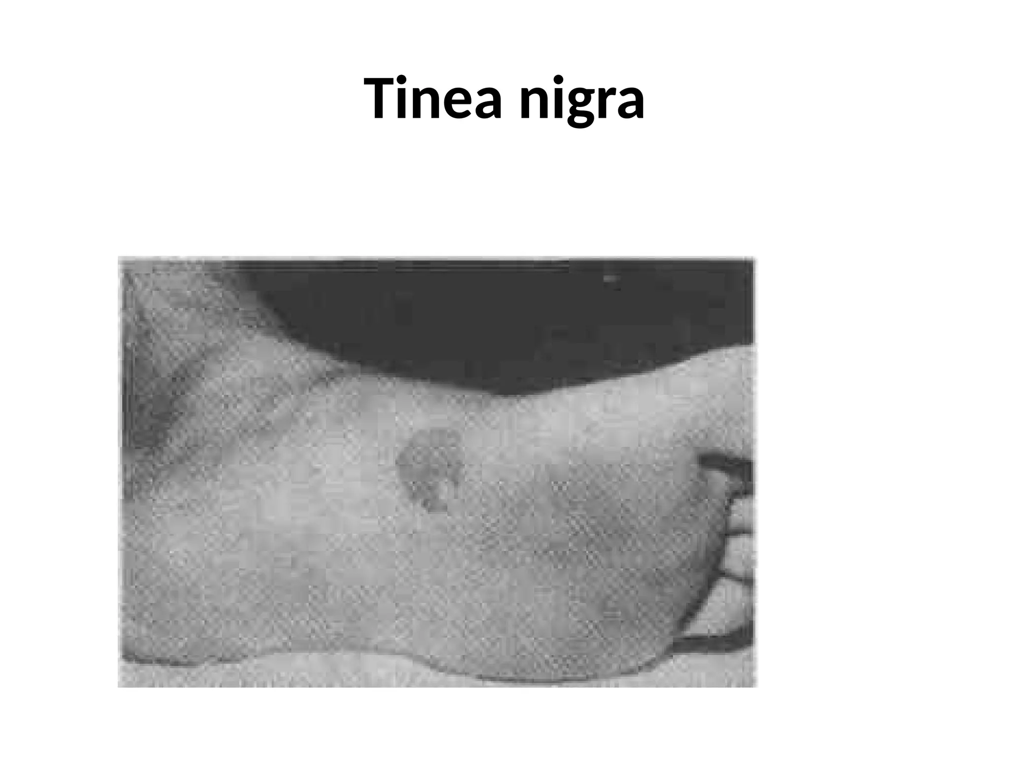 3 Pityriasis, nigra, piedra.pptx mycology | PPTX
