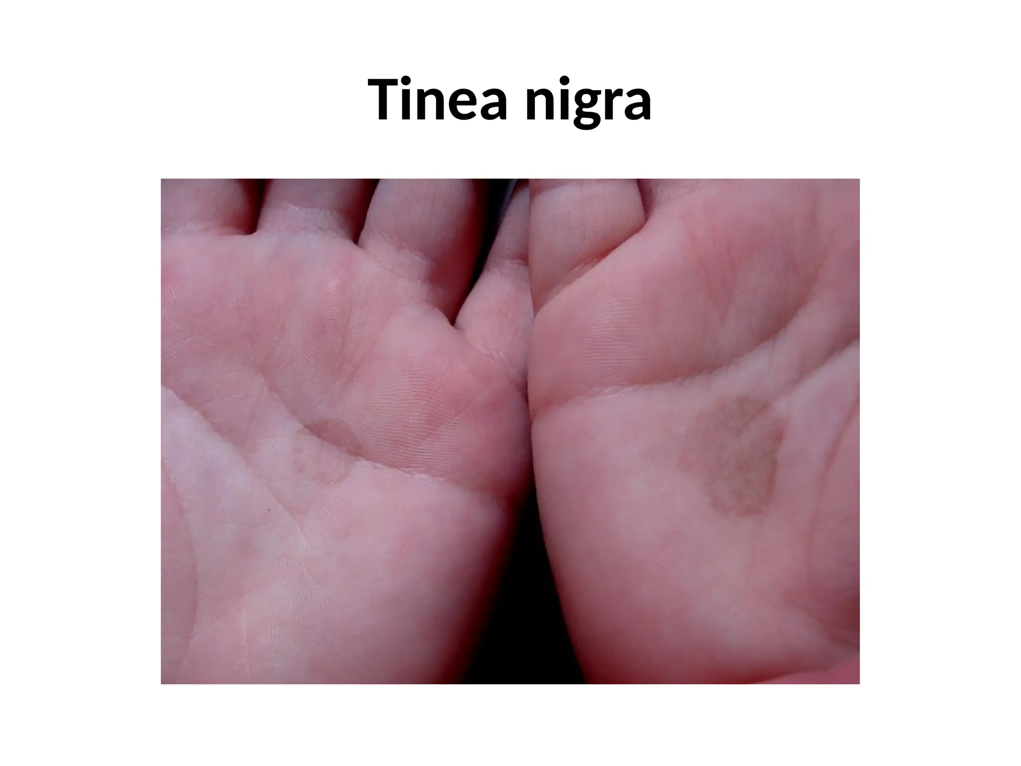 3 Pityriasis, nigra, piedra.pptx mycology | PPTX