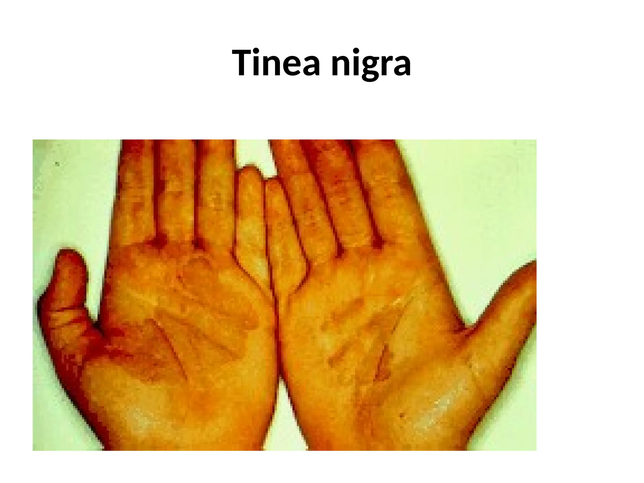 3 Pityriasis, nigra, piedra.pptx mycology | PPTX