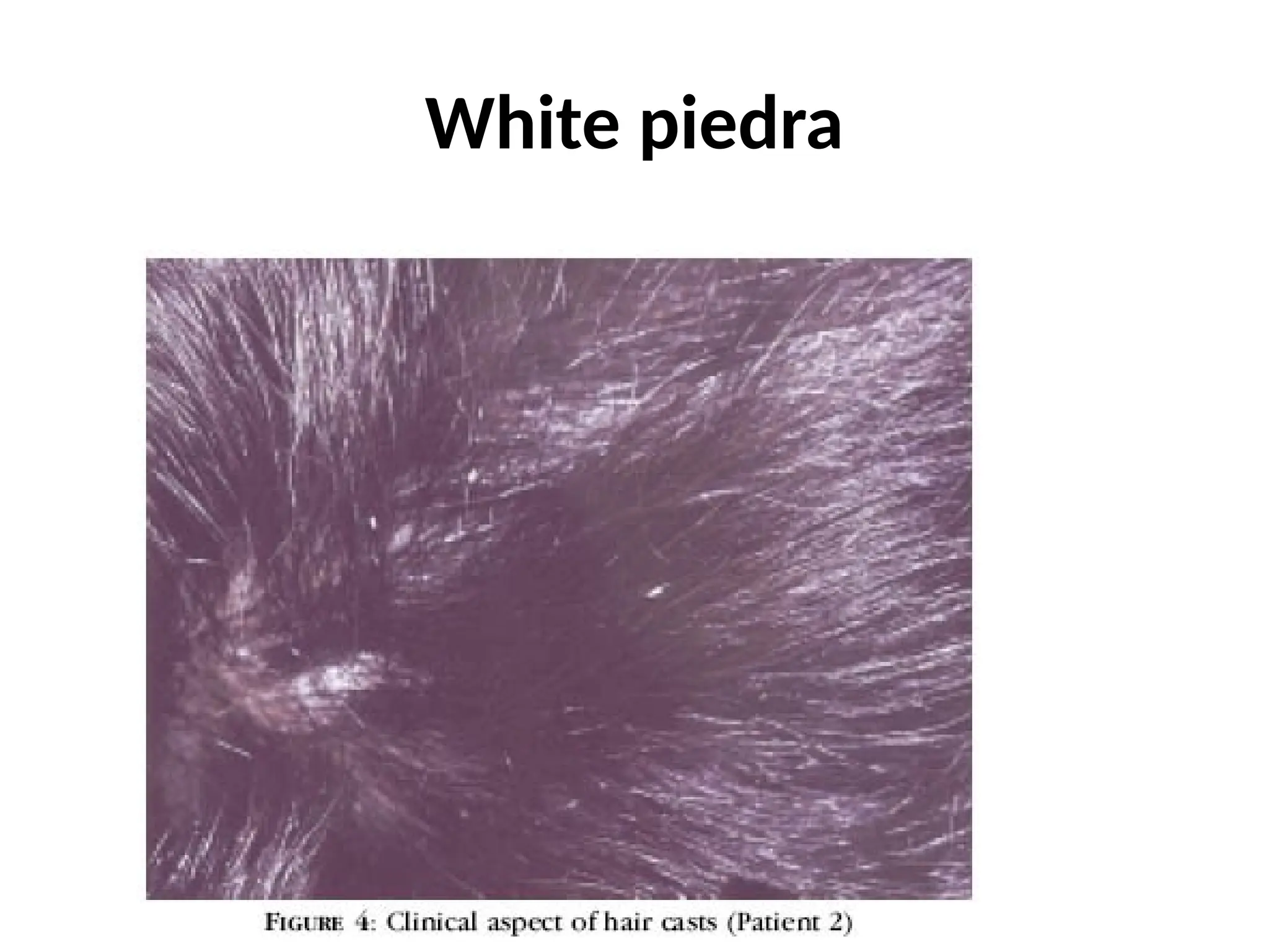 3 Pityriasis, nigra, piedra.pptx mycology | PPTX