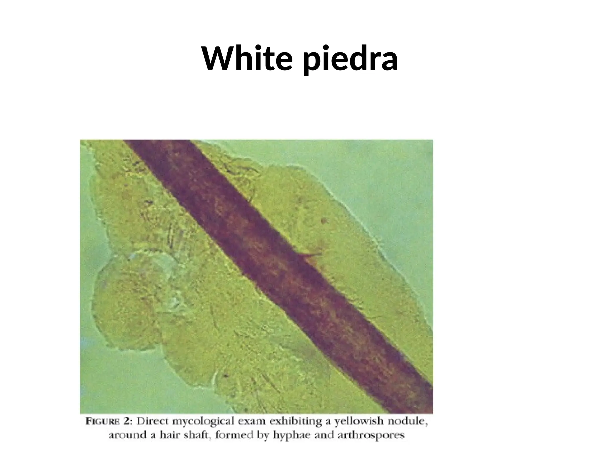 3 Pityriasis, nigra, piedra.pptx mycology | PPTX