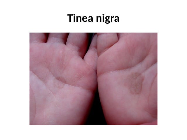 3 Pityriasis, nigra, piedra.pptx mycology | PPT