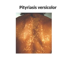 3 Pityriasis, nigra, piedra.pptx mycology | PPT