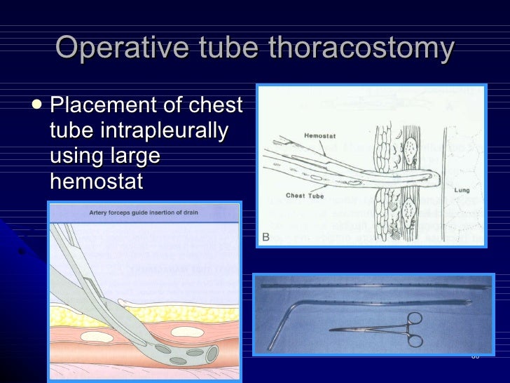 3 pneumothorax