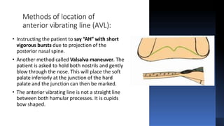 3 Posterior palatal seal area lecture.pptx