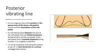 3 Posterior palatal seal area lecture.pptx