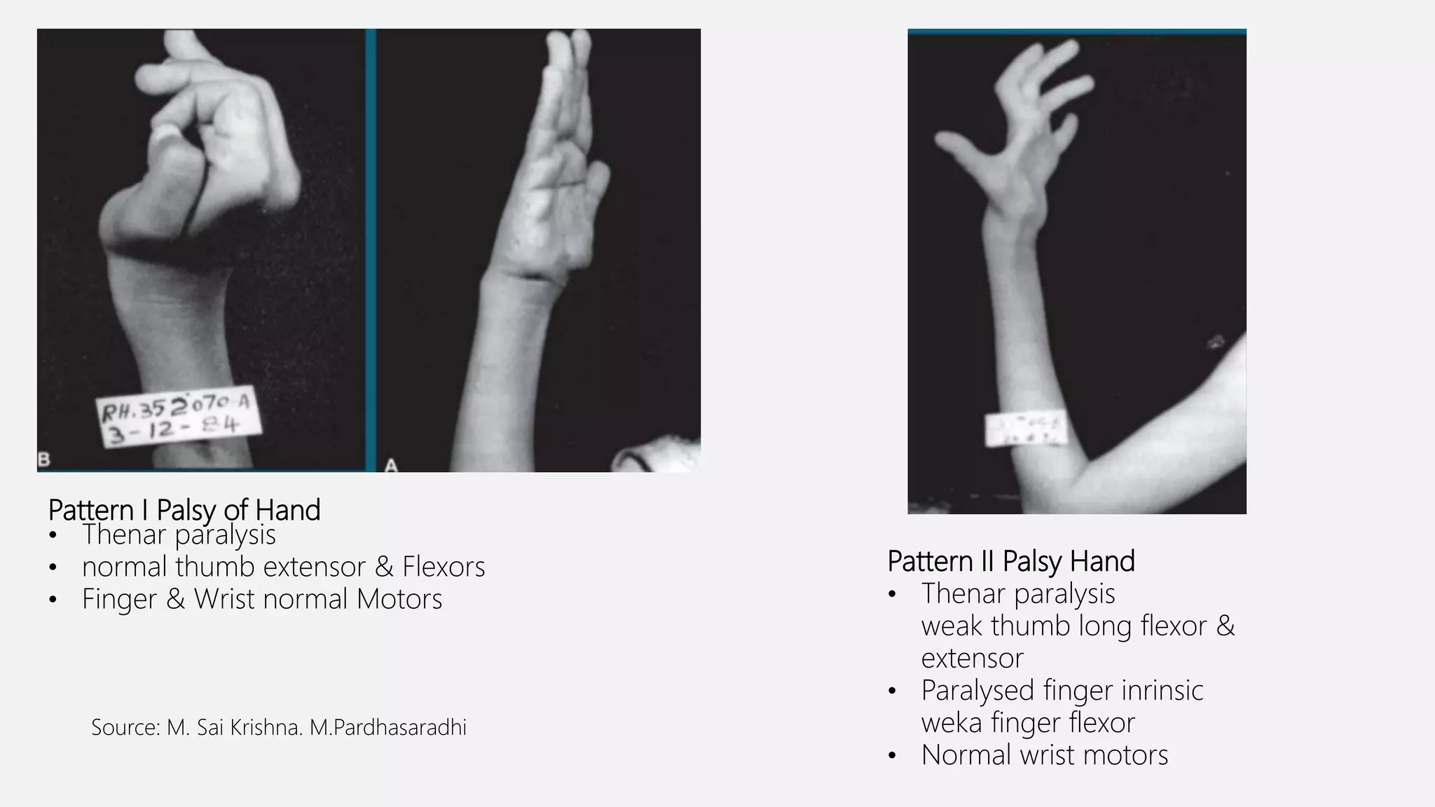 Post Polio residual Palsy & Deformities part3 Upper limb | PPT
