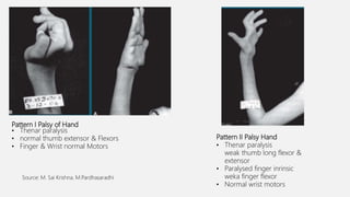 Post Polio residual Palsy & Deformities part3 Upper limb | PPTX