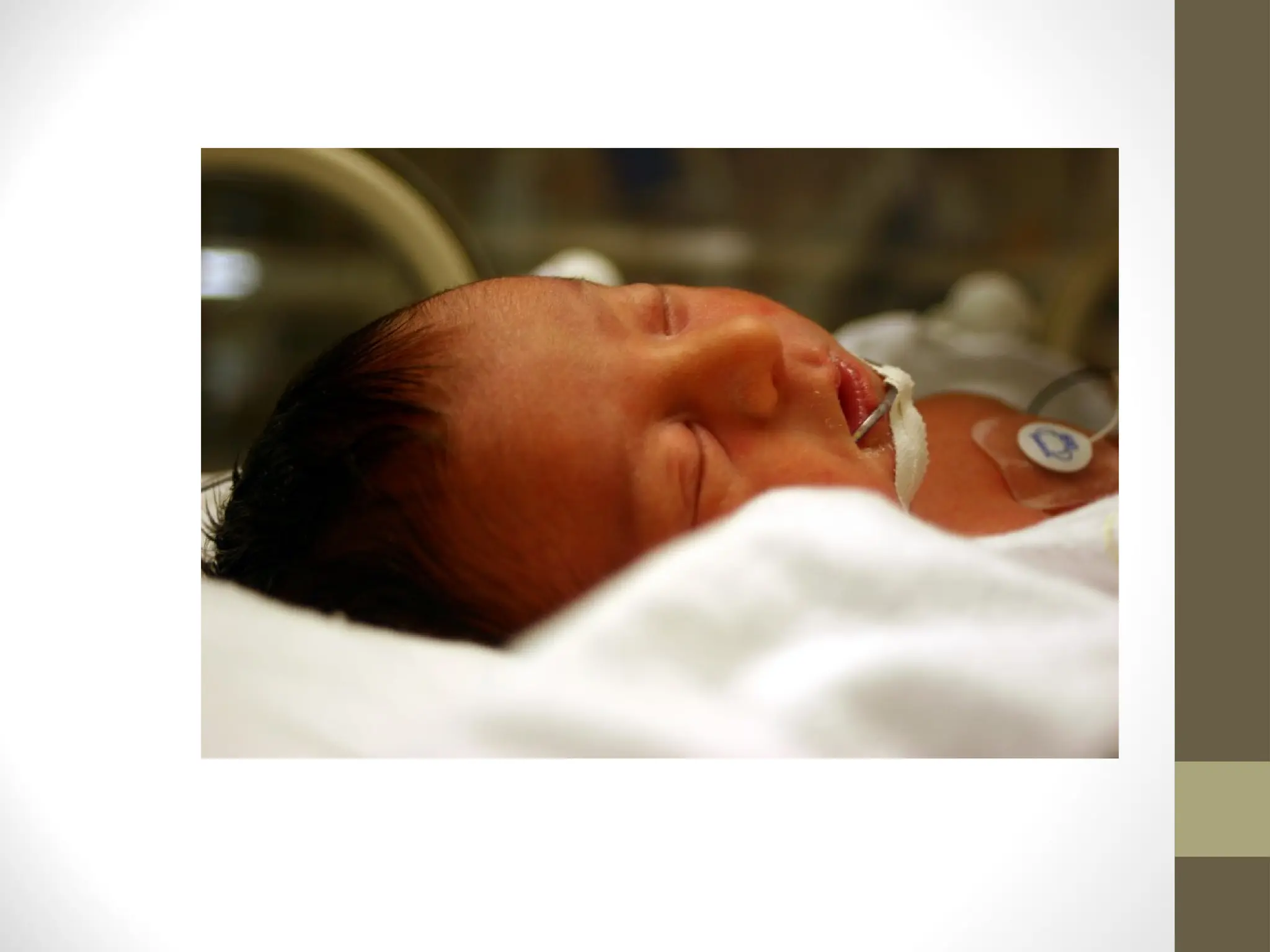 3 Preterm Rupture of Membranes.pptggdsahkv | PPT