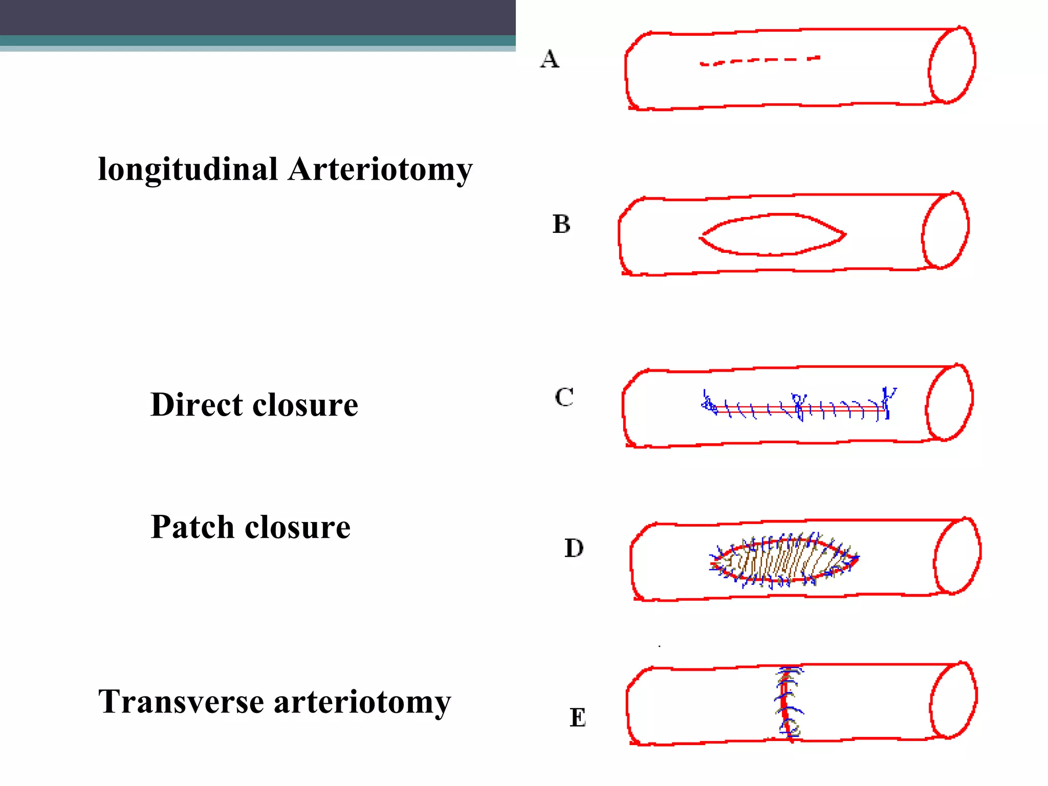 3 print version nurses basics of vascular surgery Open heart surgery | PPT