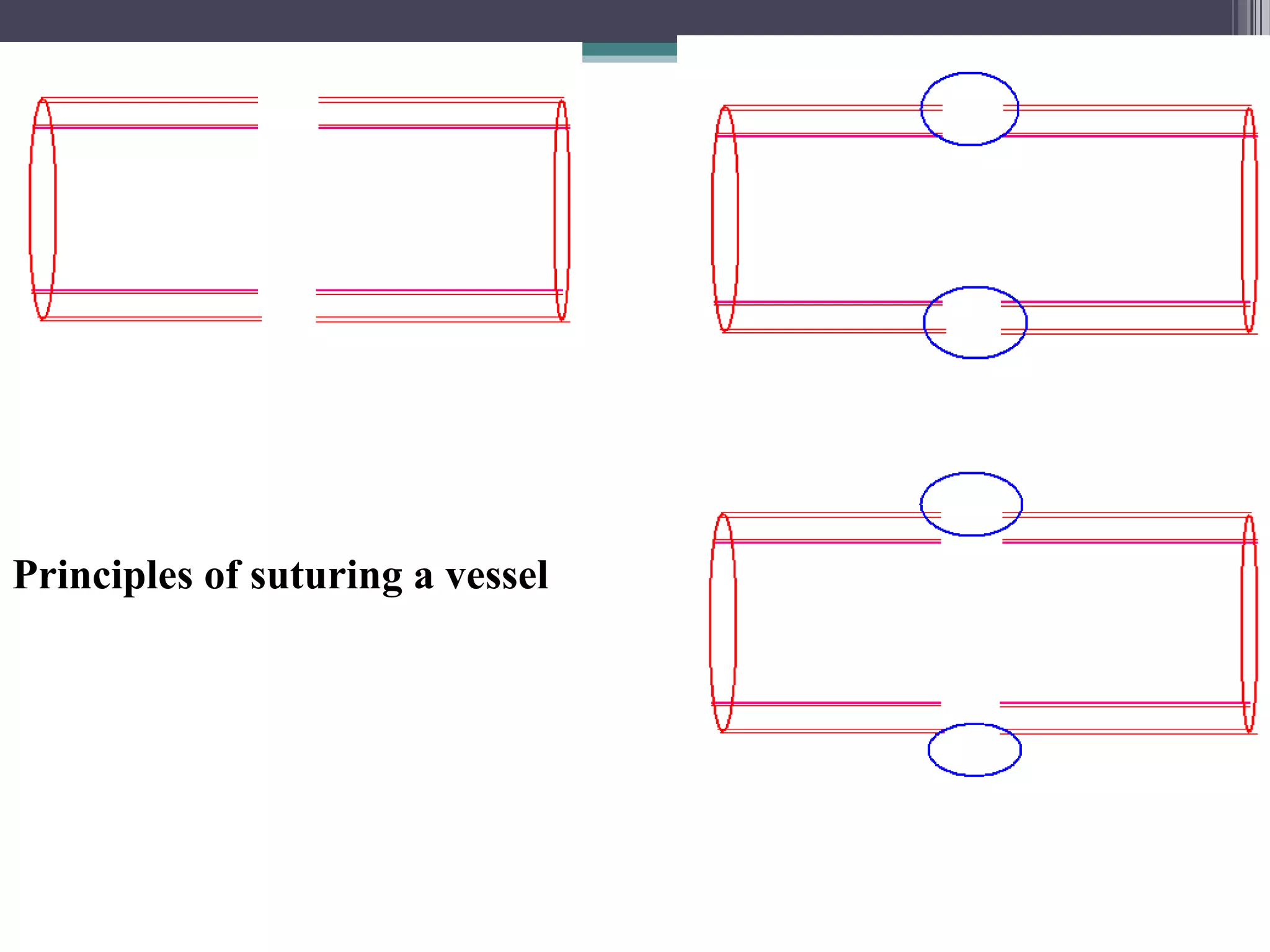 3 print version nurses basics of vascular surgery Open heart surgery | PPT