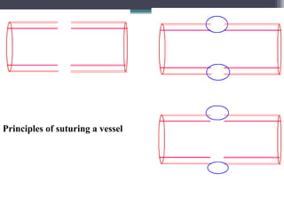 3 print version nurses basics of vascular surgery Open heart surgery | PPT
