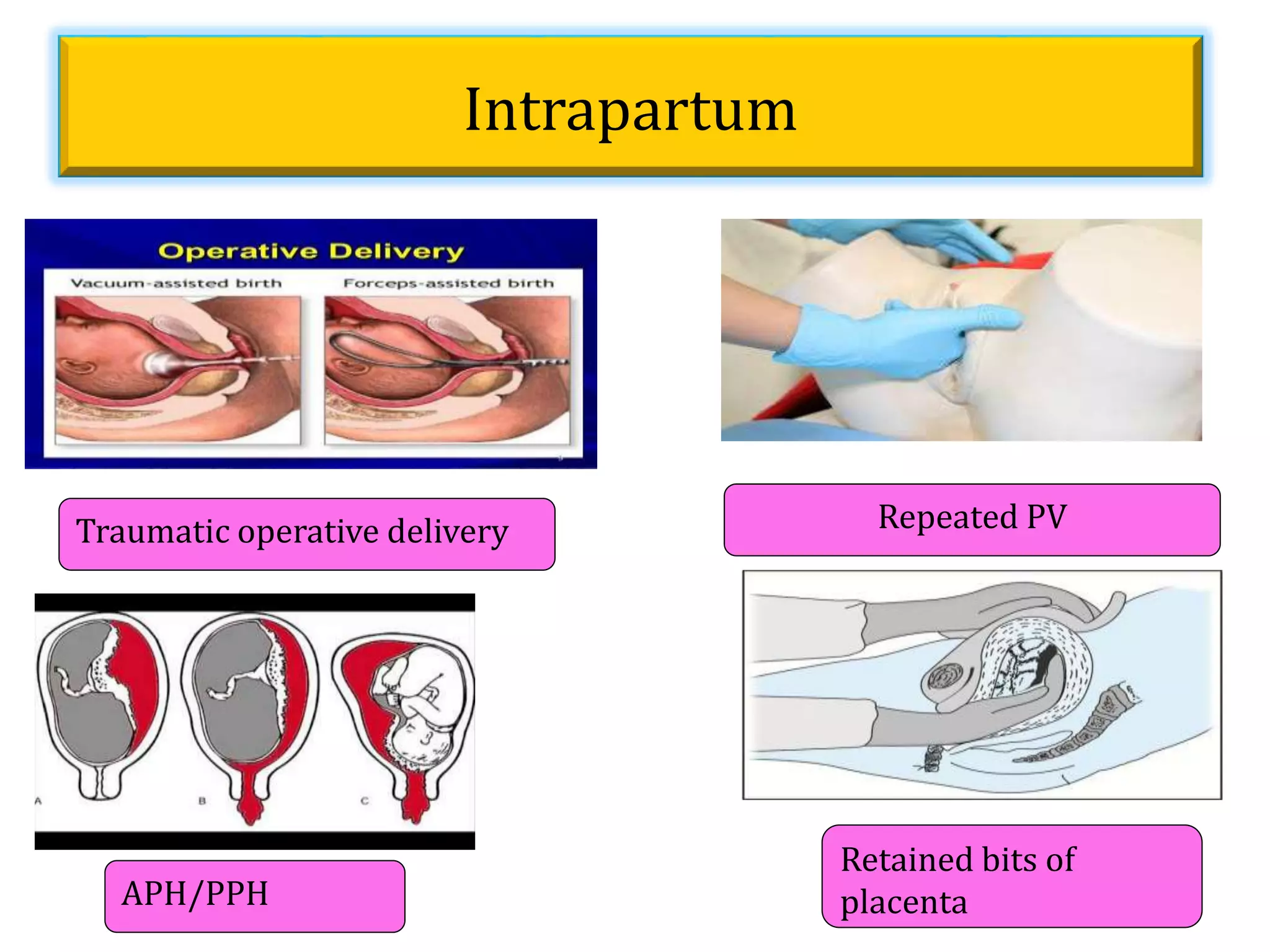 Puerperal Infection | PPTX