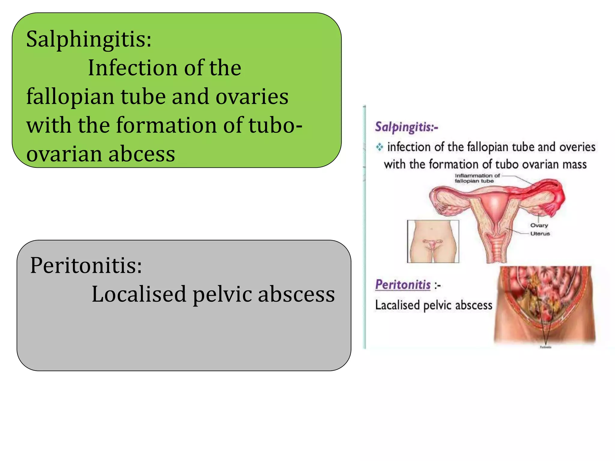Puerperal Infection | PPTX