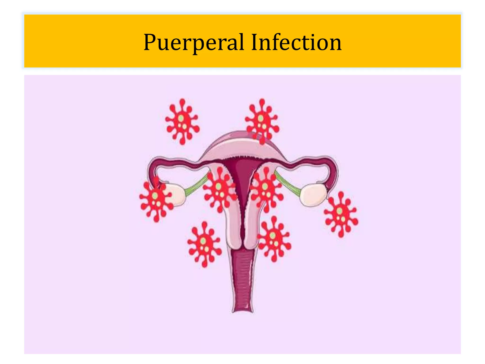 Puerperal Infection | PPTX