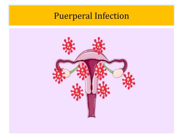 Puerperal Infection | PPTX | Pregnancy | Reproductive Health