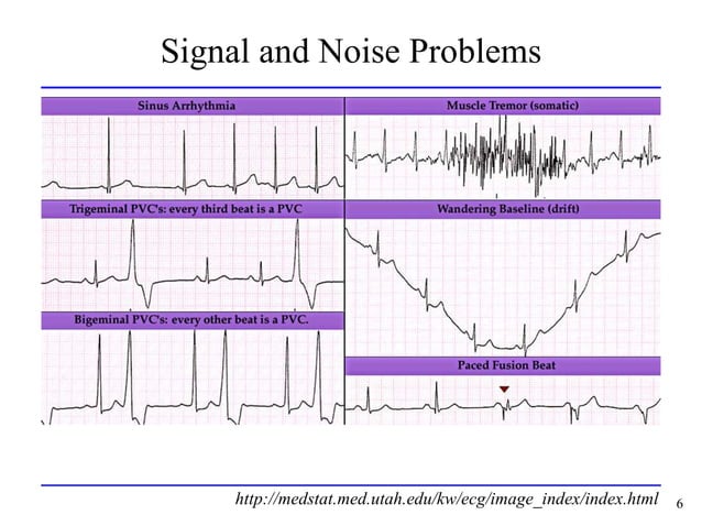 QRS detection is important in all kinds of ECG signal processing | PPT